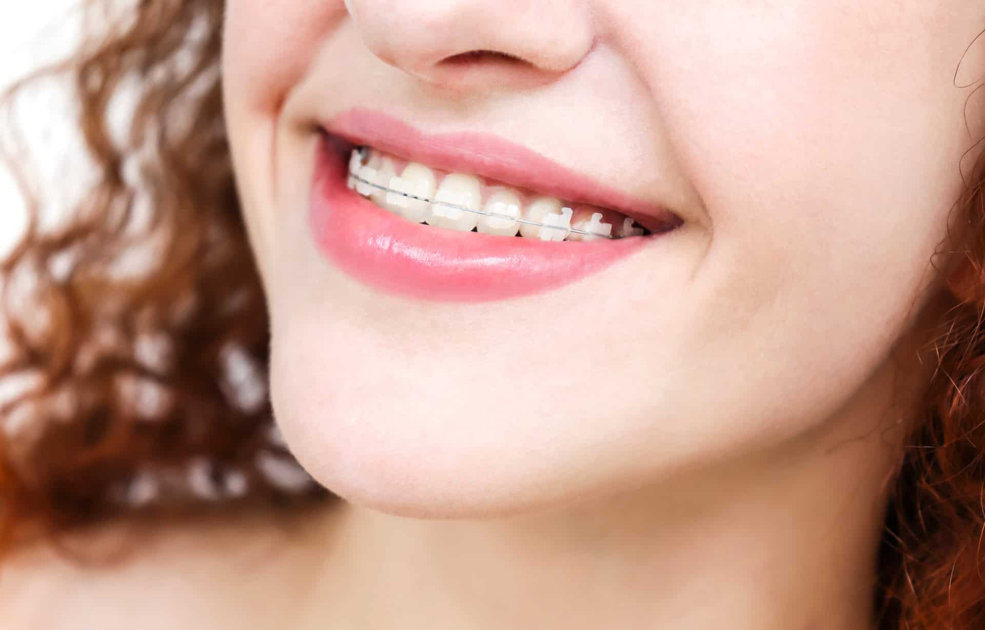 Ceramic Braces in Castle Pines, CO - Castle Pines Orthodontics
